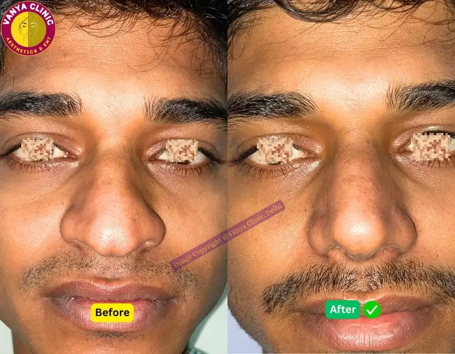 Rhinoplasty price store